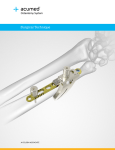 Acumed Elbow Plating System Surgical Technique | Manualzz