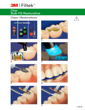 3M Filtek™ One Bulk Fill Restorative Application Guide | Manualzz