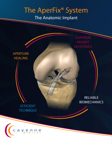 Zimmer AperFix II Tibial Sheath and Screw System Owner's Manual | Manualzz
