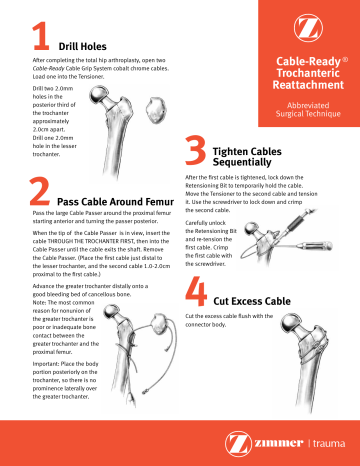 Zimmer Cable-Ready Cable Grip System Owner's Manual | Manualzz