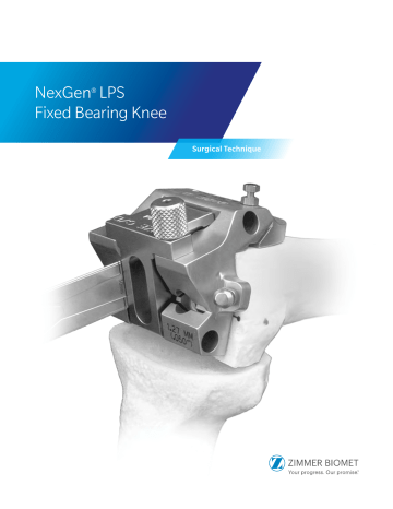 Zimmer NexGen Complete Knee Solution Owner's Manual | Manualzz