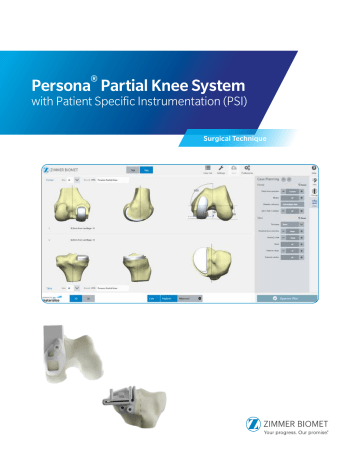 Zimmer Persona Partial Knee Owner's Manual | Manualzz