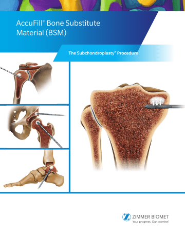 Zimmer The Subchondroplasty (SCP) Procedure Owner's Manual | Manualzz
