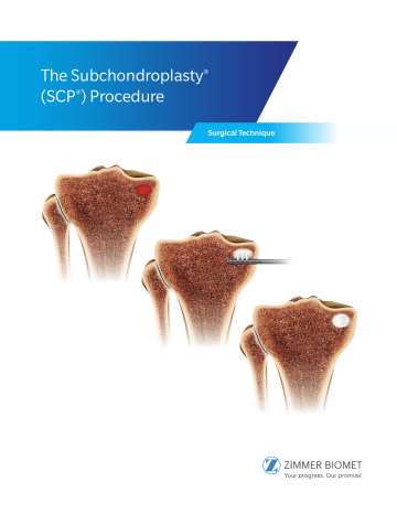 Zimmer The Subchondroplasty (SCP) Procedure Owner's Manual | Manualzz