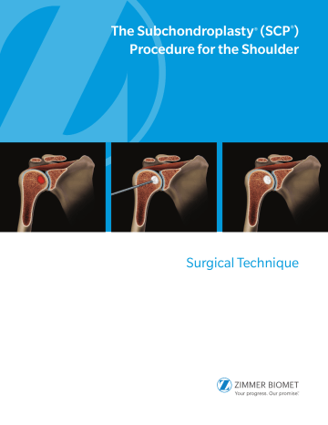 Zimmer The Subchondroplasty (SCP) Procedure Owner's Manual | Manualzz
