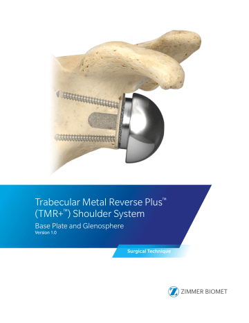 Zimmer Trabecular Metal™ Reverse Shoulder System Owner's Manual | Manualzz